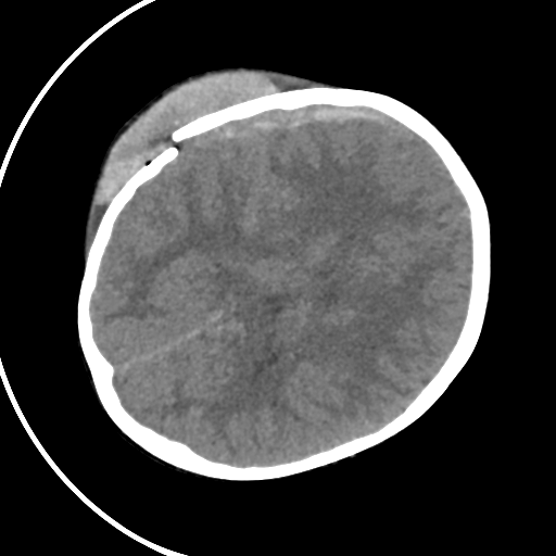 brain-bleeding Object Detection Dataset by Artamananda