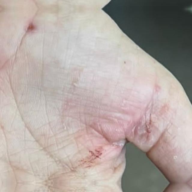 scabies Object Detection Model (v1, 2025-04-09 12:48am) by scabies