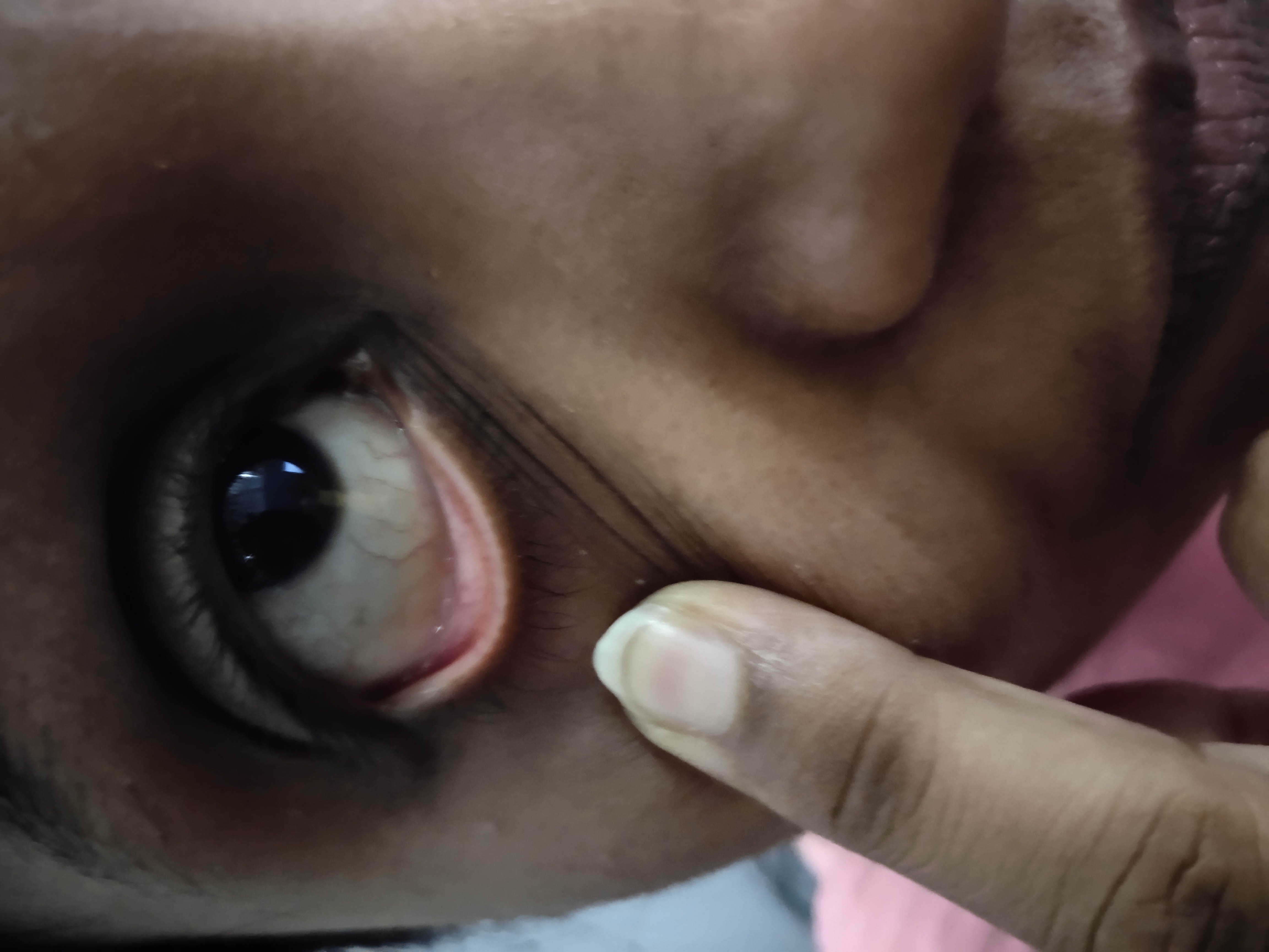 Conjunctiva_Segmentation Instance Segmentation Model by Hemoglobin