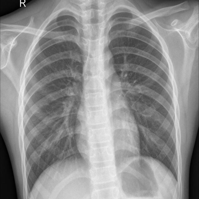 chest-xray-image_s Classification Model by Universidad