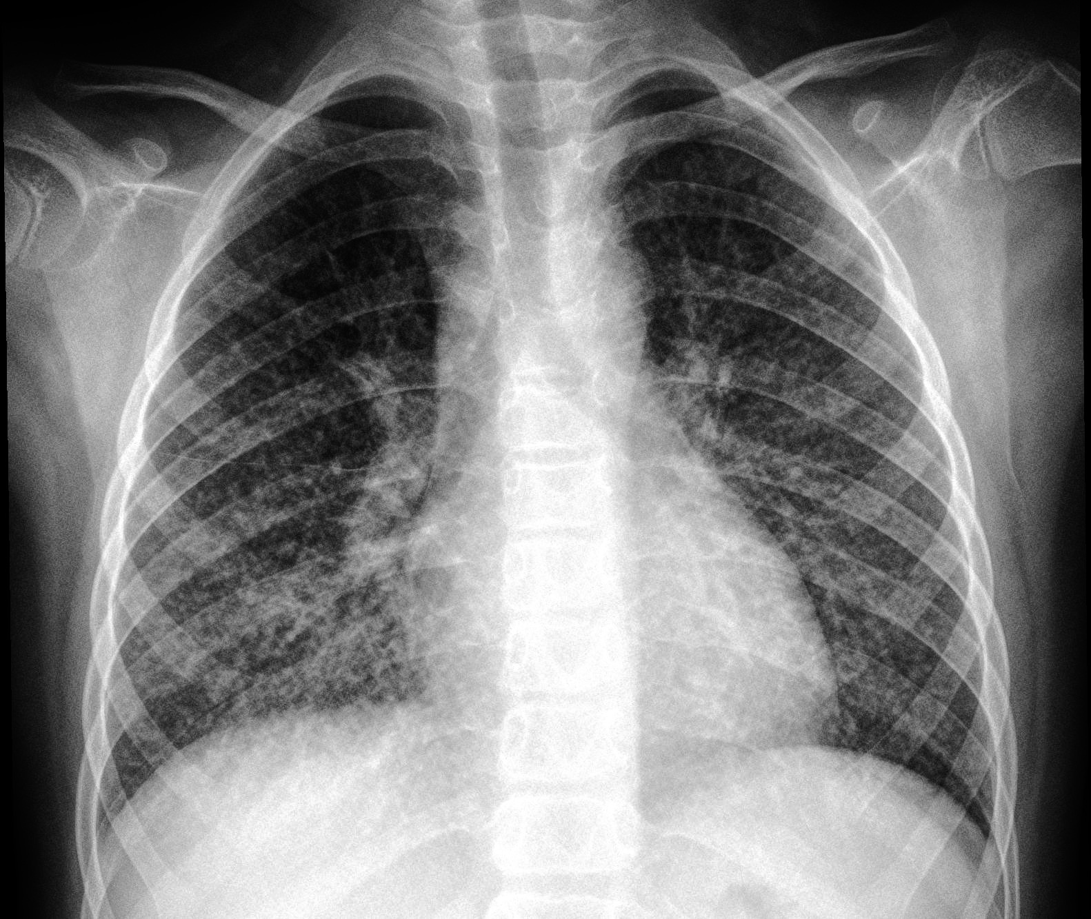 X-ray_datasettest Classification Dataset by Kitsana Uyaphitang