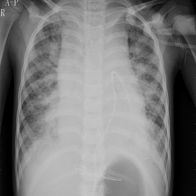 Pneumonia Detection Classification Dataset And Pre Trained Model By