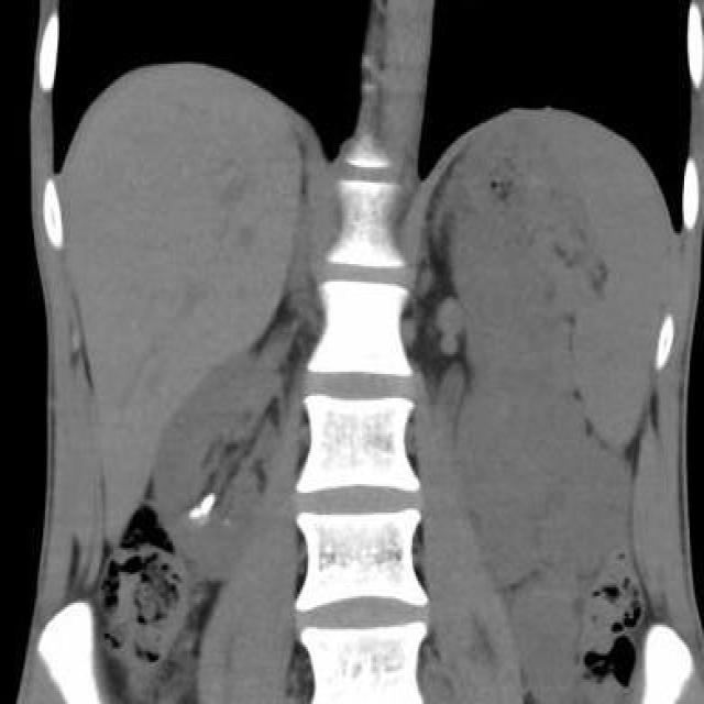 Kidney-disease-balanced Object Detection Dataset by East West University
