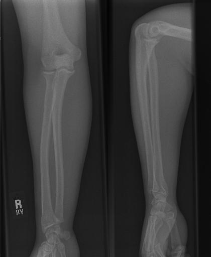 Bone fractures Instance Segmentation Model by Omniware
