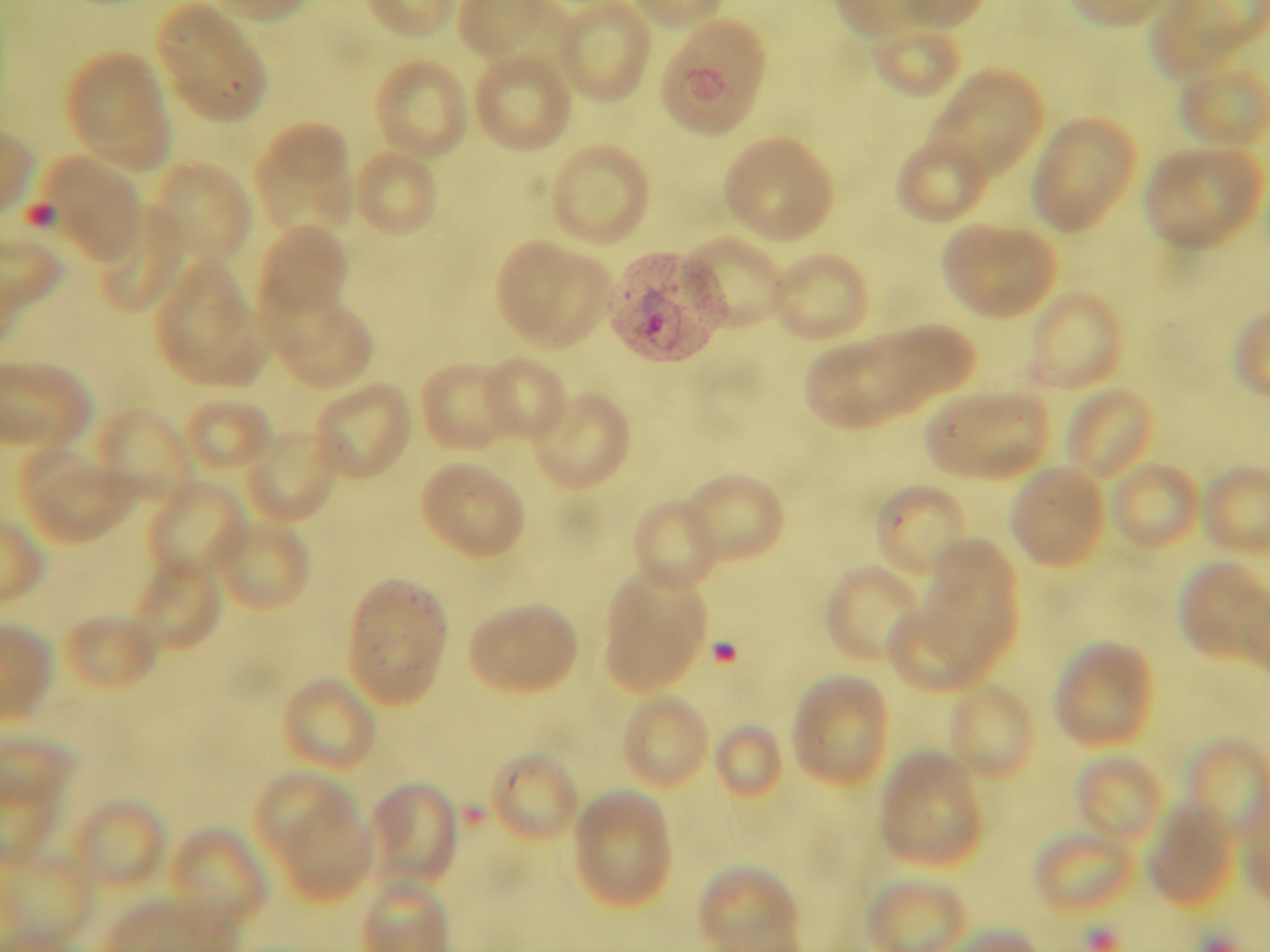 malaria_diagmal Object Detection Dataset by MalariaSystem