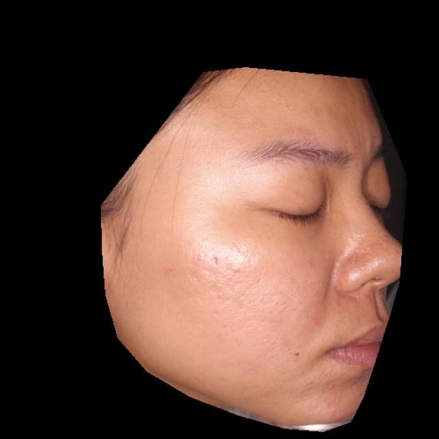 Acne Yolov8 Object Detection Dataset By Skin Condition Detection