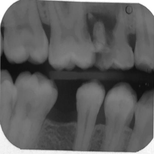 Sag_bitewing_1000 Instance Segmentation Dataset by Thammasat University