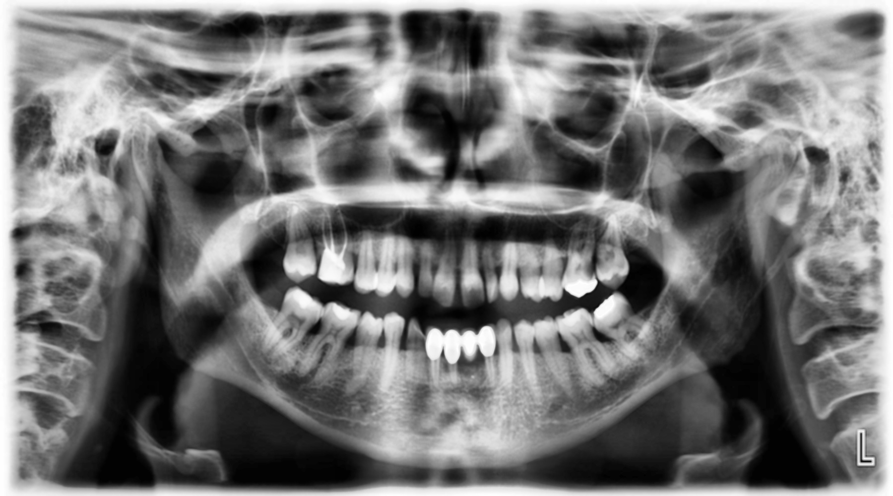Dentix Dataset Object Detection Dataset By Fay
