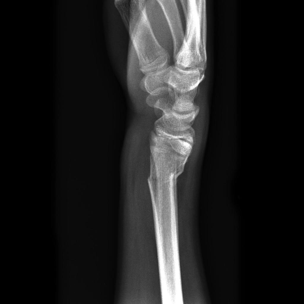 bone fracture Object Detection Dataset by RoboFlowJan2025