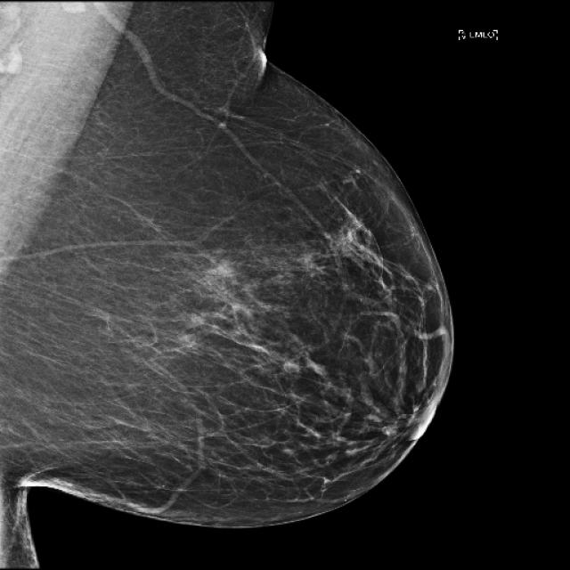 mammography Classification Dataset by lets start
