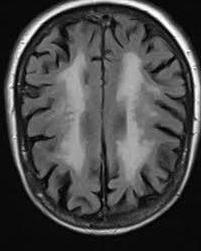 Brain Tumor Detection MRI Object Detection Model by Project MAY