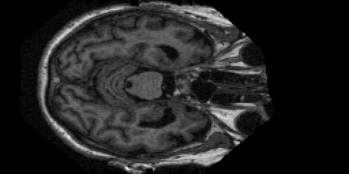 Alzheimers-dataset-oasis Classification Model by traffic violation