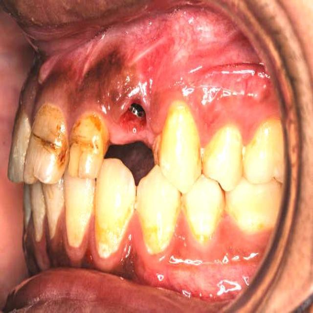 Calculus Object Detection Dataset by dental