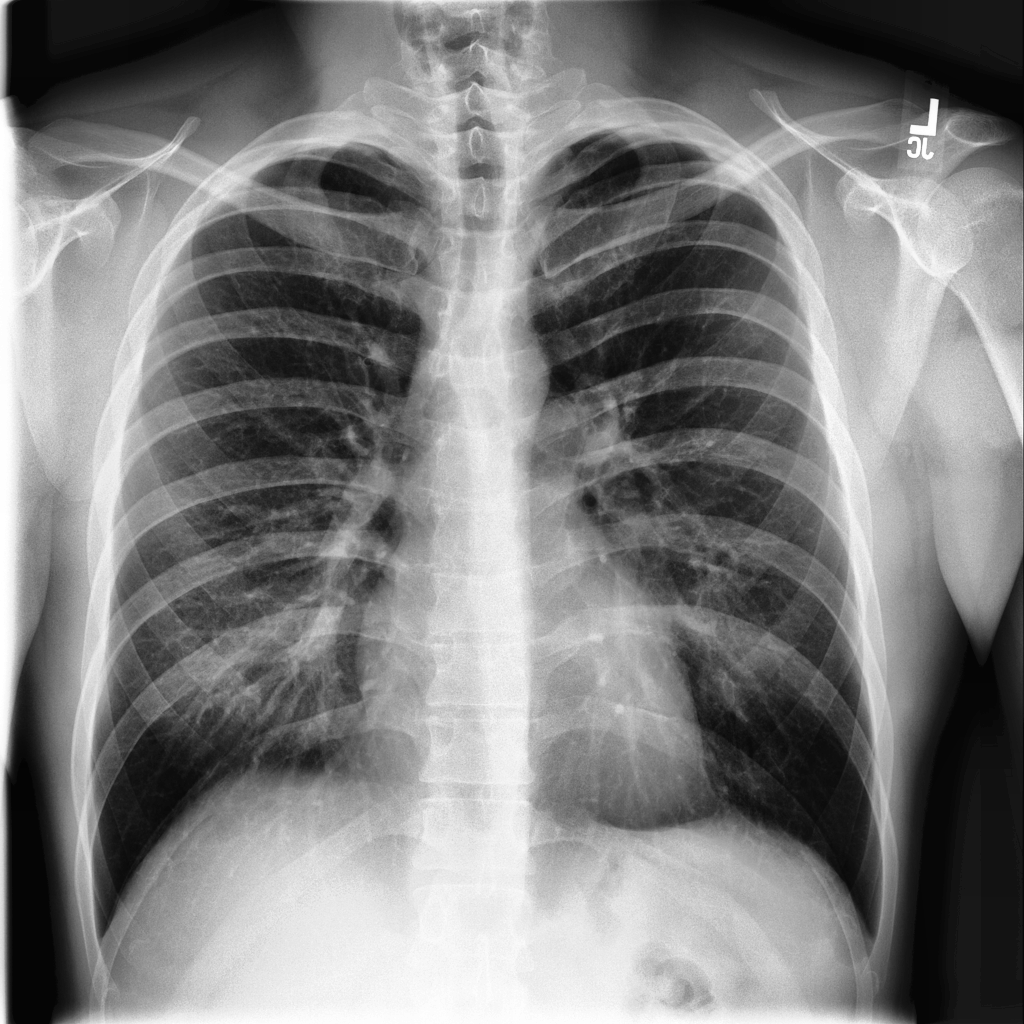 How to Use the Detection Lungs Object Detection API