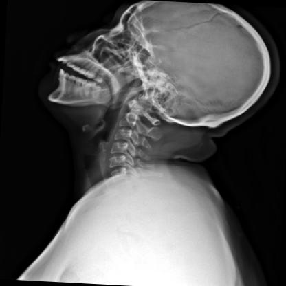Cervical Segmentation Object Detection Dataset by FYP