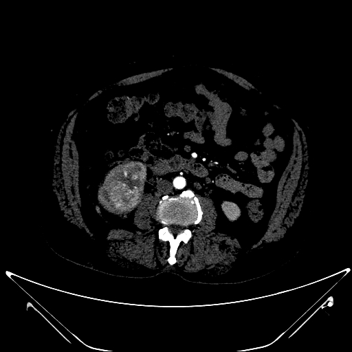 Kidney-cyst-tumor-stone Instance Segmentation Dataset (v4, v1) by college