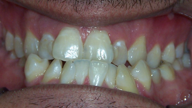 Crooked vs healthy teeth Classification Dataset by C4m