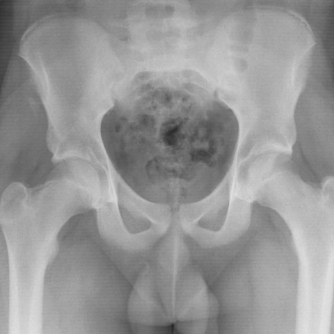 Bone Break Classification Classification Model by Curso