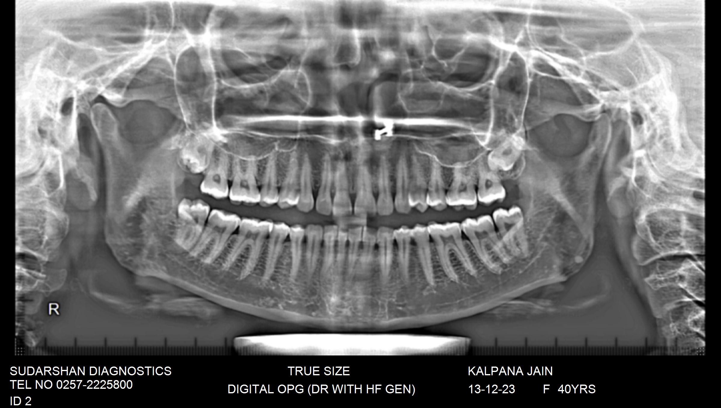 Final OPG Object Detection Dataset and Pre-Trained Model by Somaiya