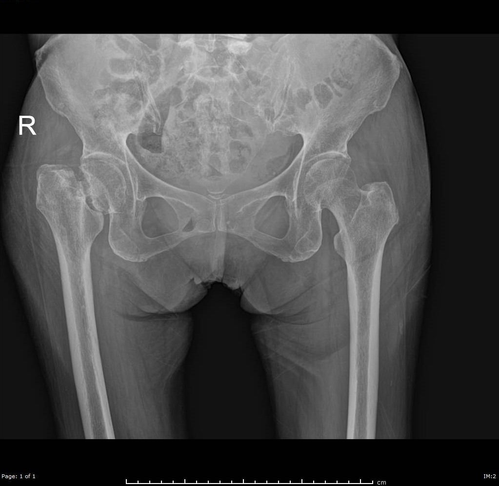 How To Use The Hip Fracture Detection Object Detection Api
