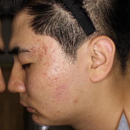 Acne Detection Object Detection Model by Acne Detection