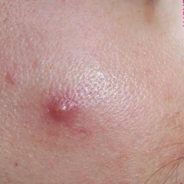 acne_v5 Instance Segmentation Dataset by skindetect