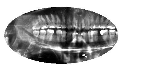 Segment Caries Instance Segmentation Dataset by Tooth Decay