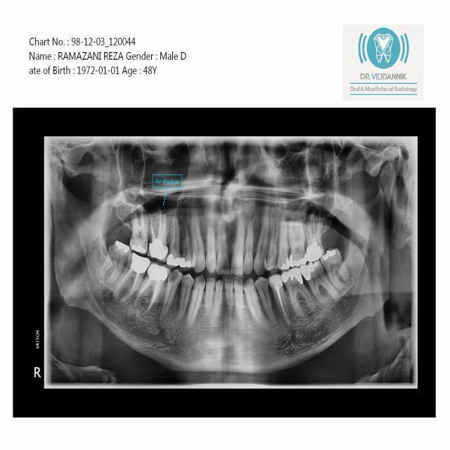 Teeth Segment Instance Segmentation Dataset and Pre-Trained Model by Tooth Decay