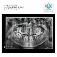 Tooth Decay (tooth-decay-gox4n) - Roboflow Universe