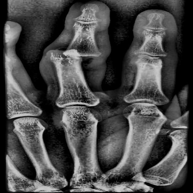 X-ray hands Object Detection Dataset by d8m