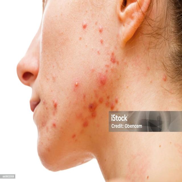 acne_v3 Instance Segmentation Dataset by projectworkspace2