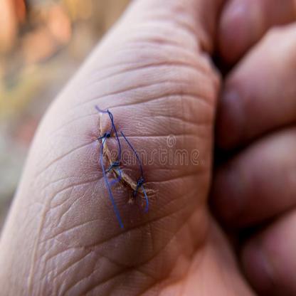 Stitches Object Detection Dataset and Pre-Trained Model by ...