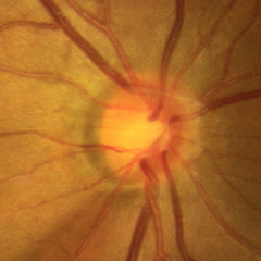 glaucoma detection Classification Dataset by glaukoma korea