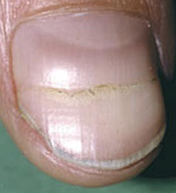 How to Use the Diabetic Nail Infection Object Detection API