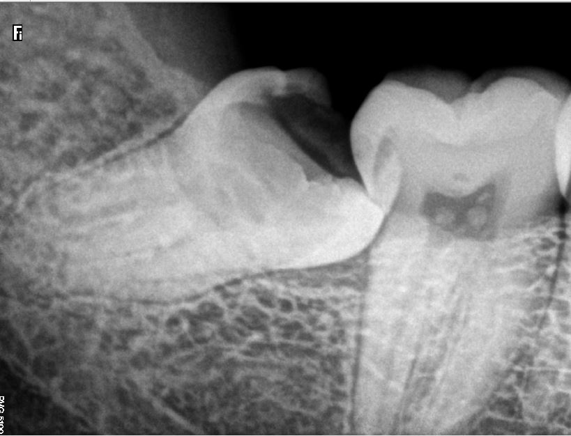 Cavitydetection Roboflow Universe