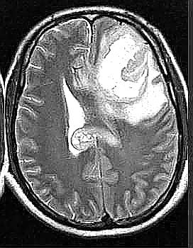 nodules Object Detection Dataset and Pre-Trained Model by Yeditepe