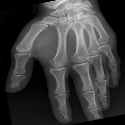 Bone Fracture Detection Mixed Object Detection Model by TesisDiaz
