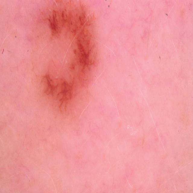 skin cancer segmentation Object Detection Dataset and Pre-Trained Model ...