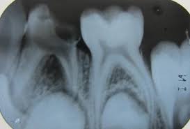 Caries Detection Object Detection Dataset and Pre-Trained Model by DrUjjaval