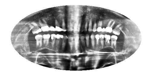 Early Caries Detection Object Detection Dataset by cavity