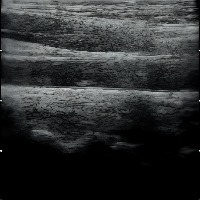 Carotid artery Project - Roboflow Universe