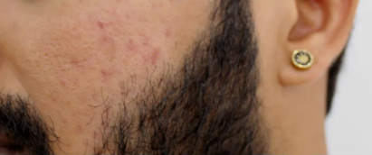 acne_model Object Detection Model by rounak