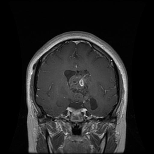 brain_tumer_detection Object Detection Dataset and Pre-Trained Model by ...