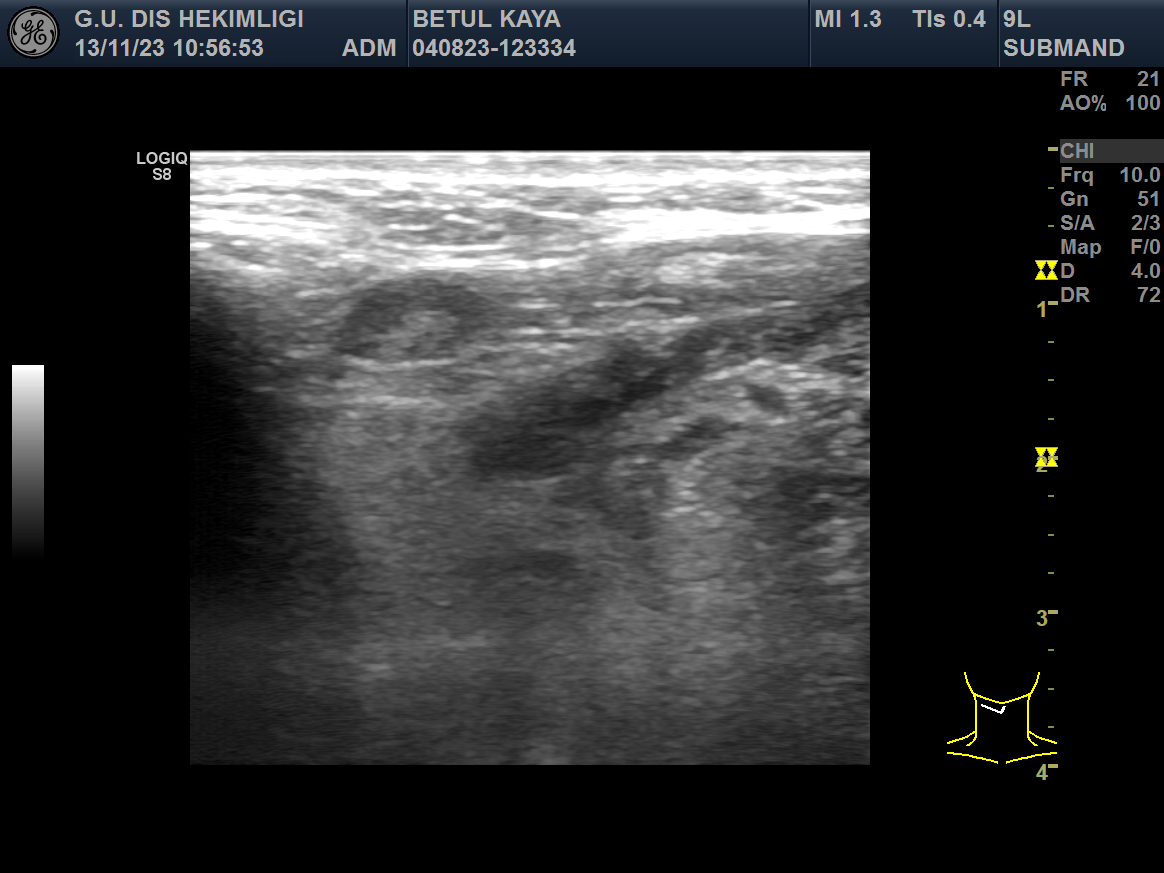 Lymph Node Instance Segmentation Dataset by gaziantep university