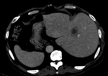 Liver Tumor detection Object Detection Dataset and Pre-Trained Model by ...