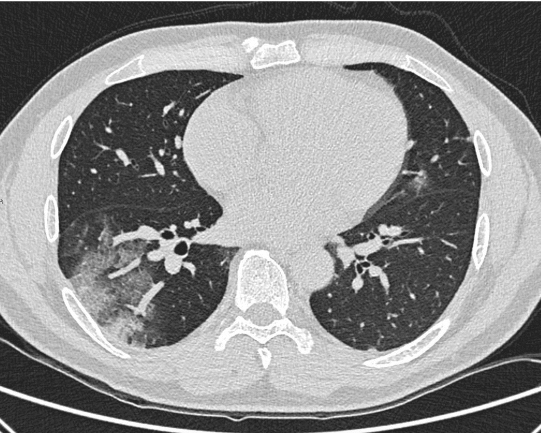 Lung-GANs-For CT scans Object Detection Dataset by projects