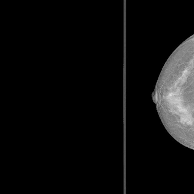 Breast Tumor Object Detection Dataset And Pre Trained Model By Brcan