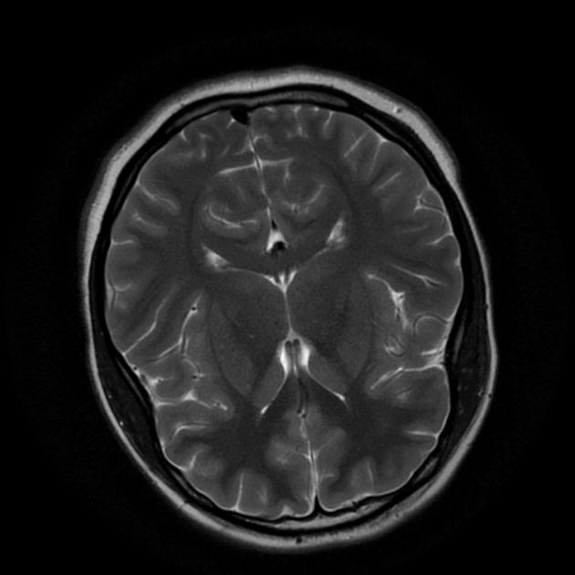 Brain Tumor Detector Brain Tumor Detector Js5w6 Roboflow Universe