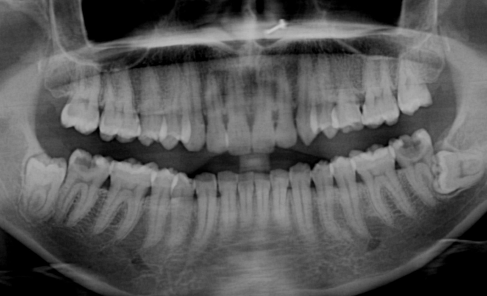 Wisdom Teeths Object Detection Dataset By Demo Detection