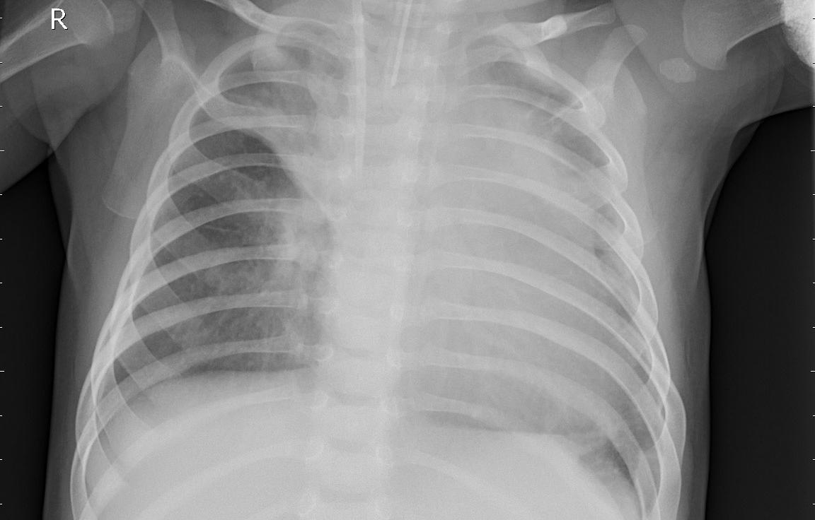 Pneumonia Object Detection Dataset by Projet ISSD